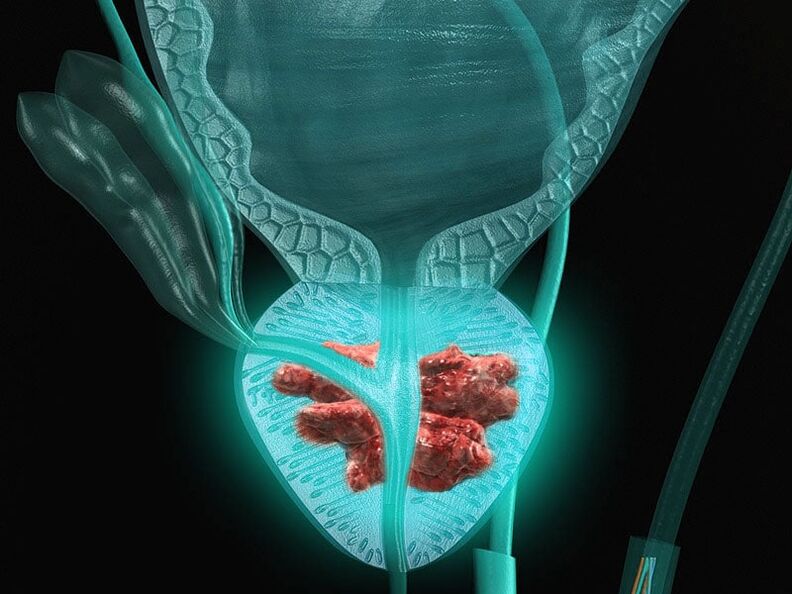 Tratamiento de la prostatitis